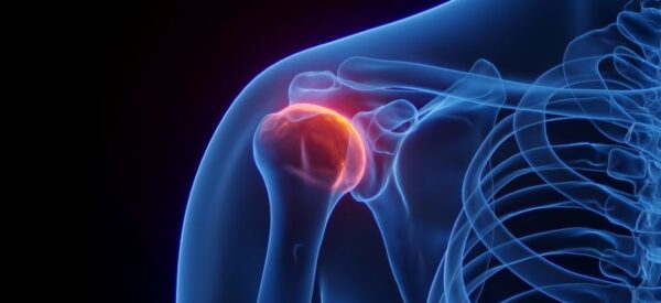 Capsulitis adhesiva o hombro congelado » AMLA