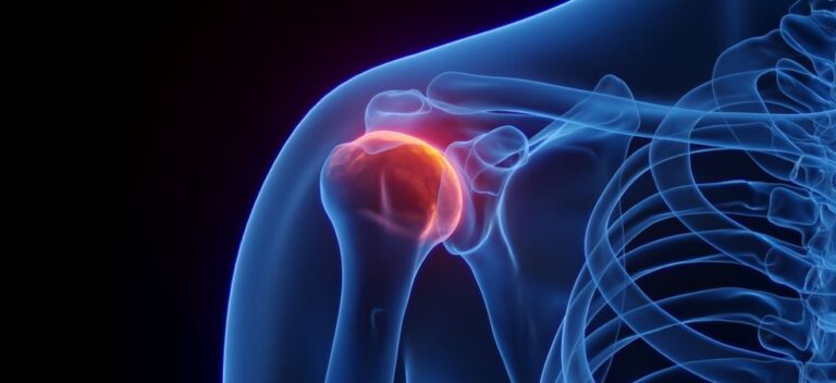 Capsulitis adhesiva o hombro congelado » AMLA