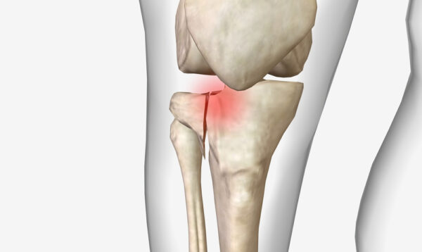 Fractura de rodilla: Causas, Síntomas y Tratamiento » AMLA