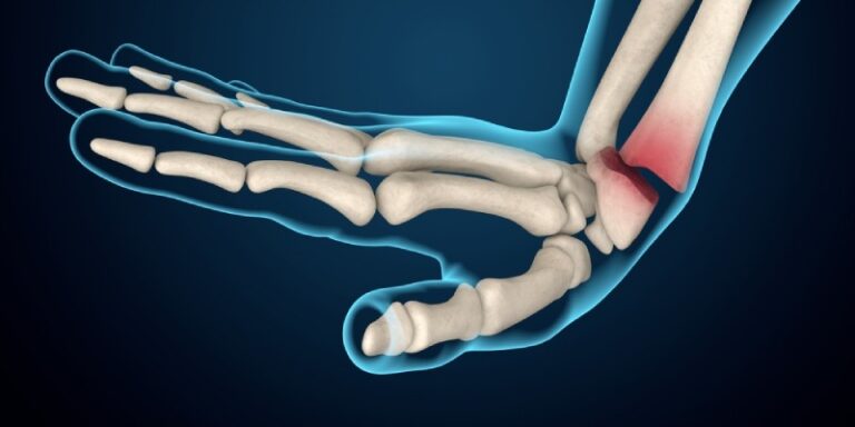 Fractura de muñeca: Causas, Síntomas y Tratamiento - AMLA