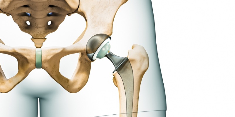 Prótesis de cadera: Causas, Síntomas y Tratamiento - AMLA